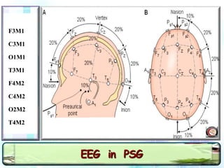 Polysomnogram interpretetion | PPTX
