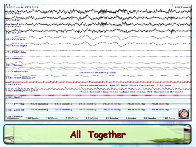 Polysomnogram interpretetion | PPTX
