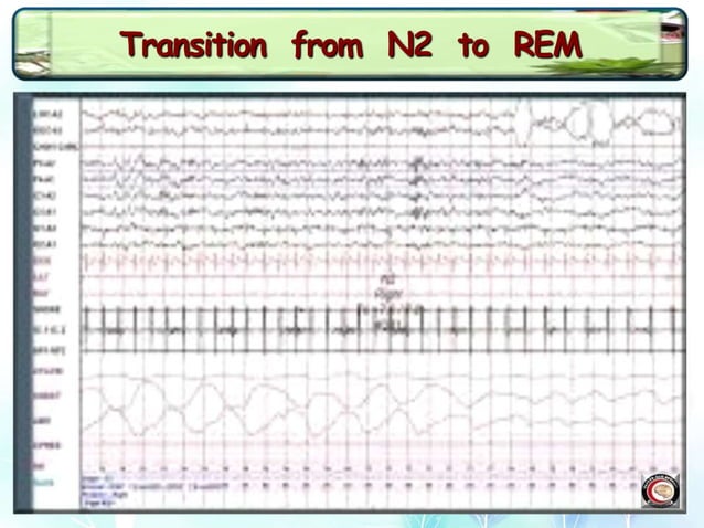 Polysomnogram interpretetion | PPTX