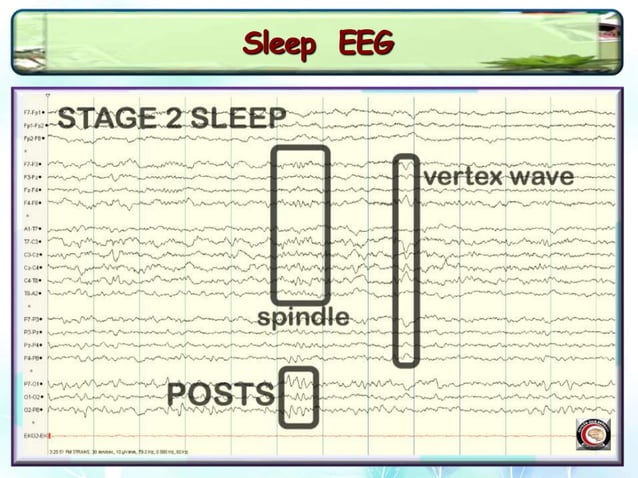 Polysomnogram interpretetion | PPTX
