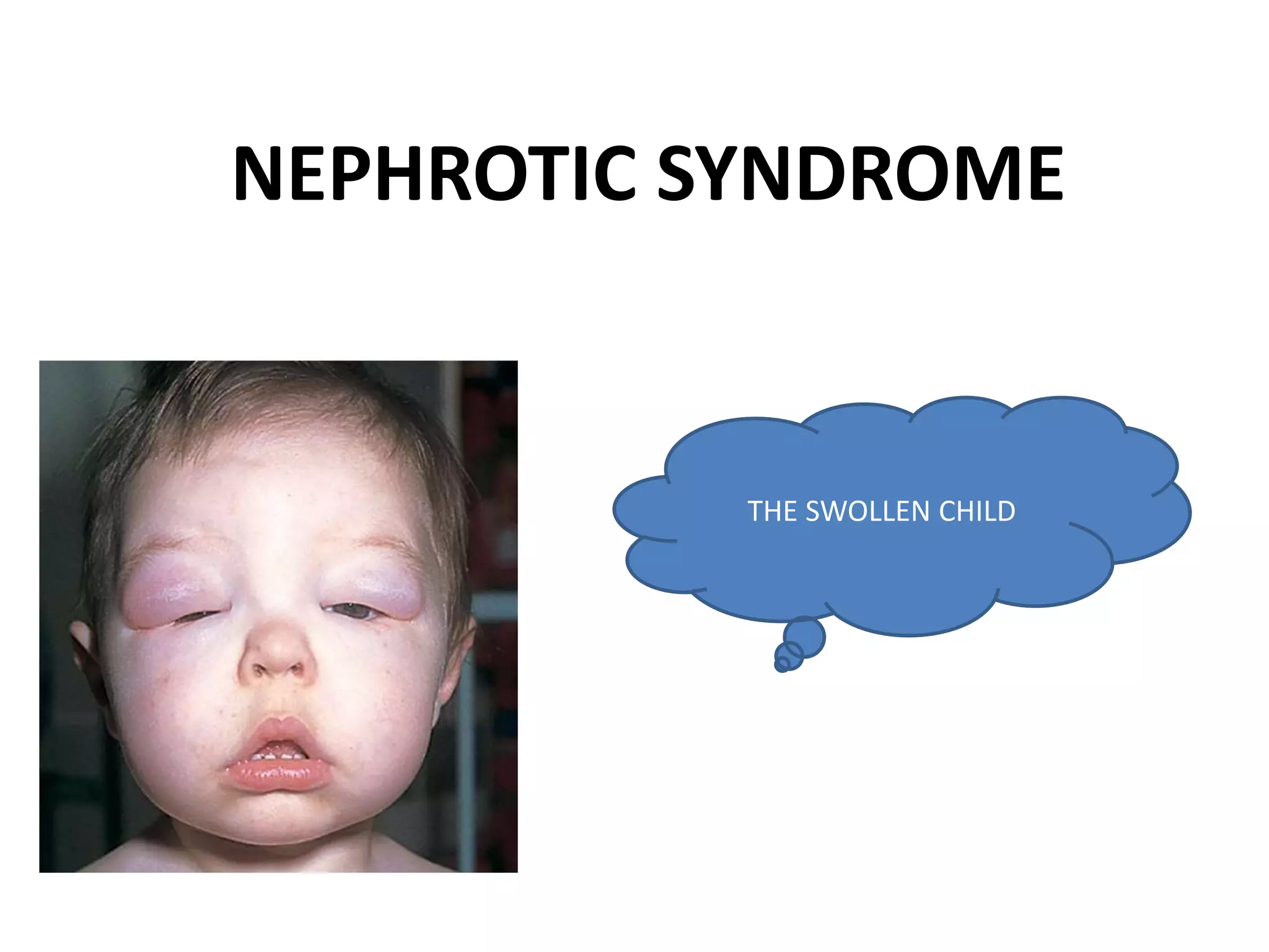 Psgn nephrotic syndrome | PPTX