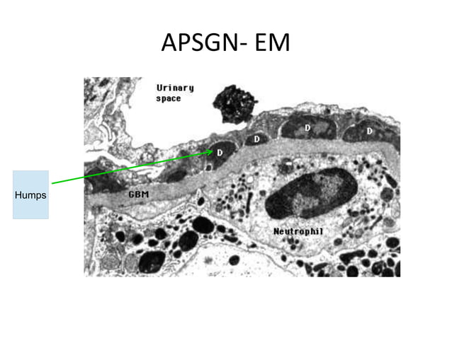 Psgn nephrotic syndrome | PPTX | Blood Disorders | Diseases and Conditions
