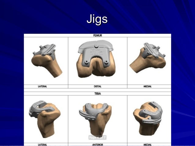 Patient Specific Instrumentation in Total Knee Replacement