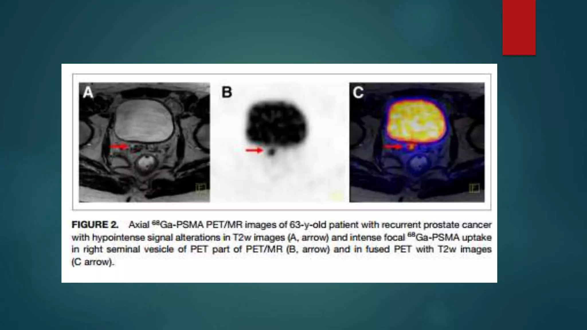 PSMA pet ct scan | PPTX
