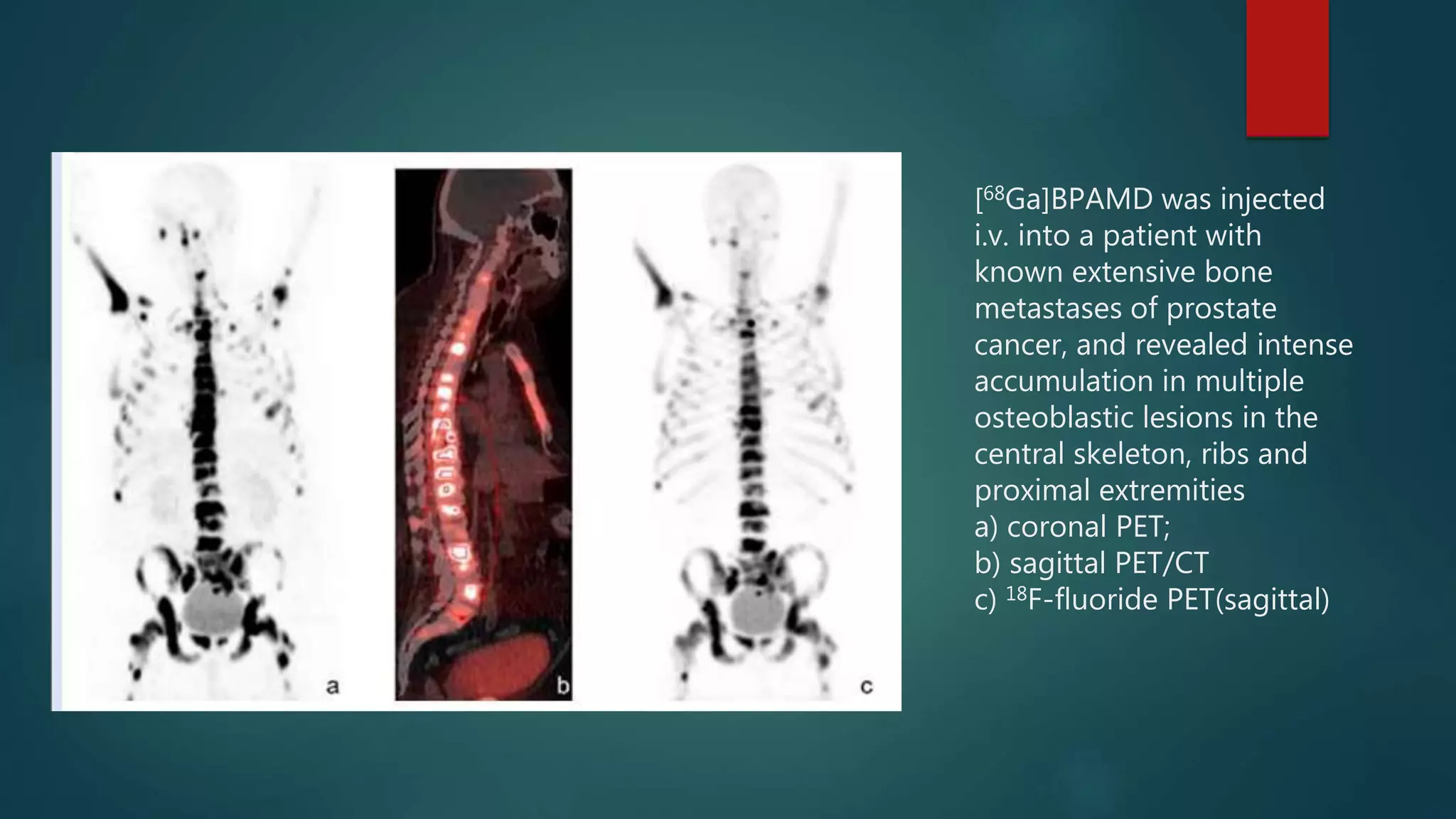 PSMA pet ct scan | PPTX