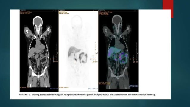 PSMA pet ct scan | PPTX | Cancer | Diseases and Conditions