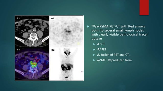 PSMA pet ct scan | PPTX | Cancer | Diseases and Conditions