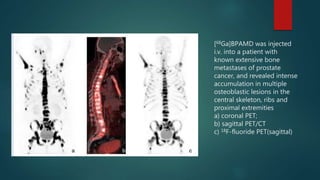 PSMA pet ct scan | PPTX