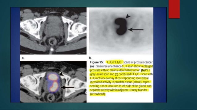 PSMA pet ct scan PSMA pet ct scan