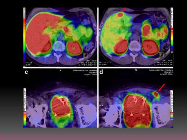 Psma pet scan