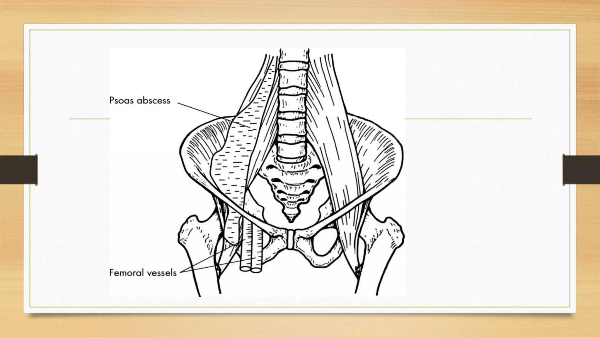 Psoas abscess | PPTX