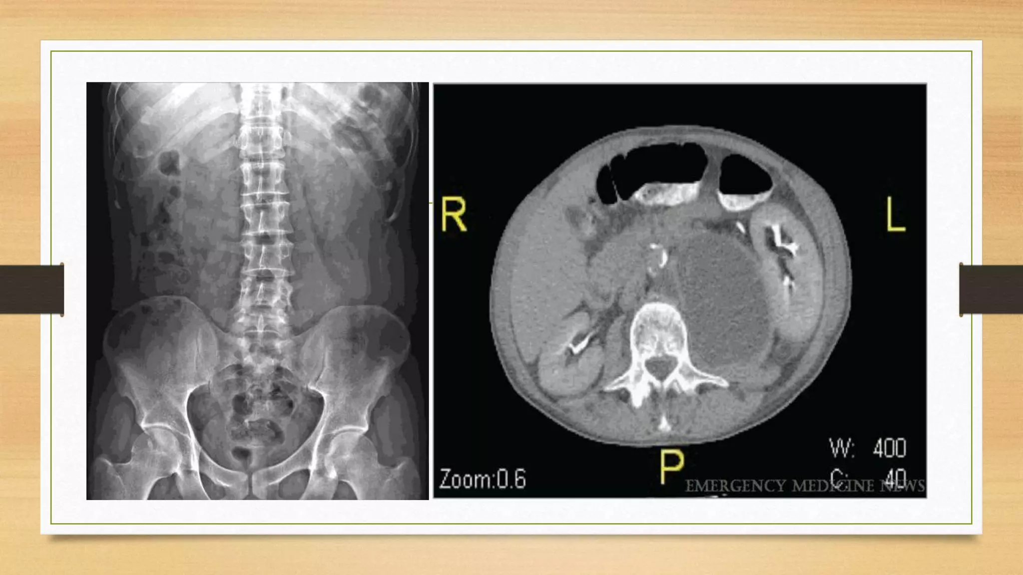 Psoas abscess | PPTX