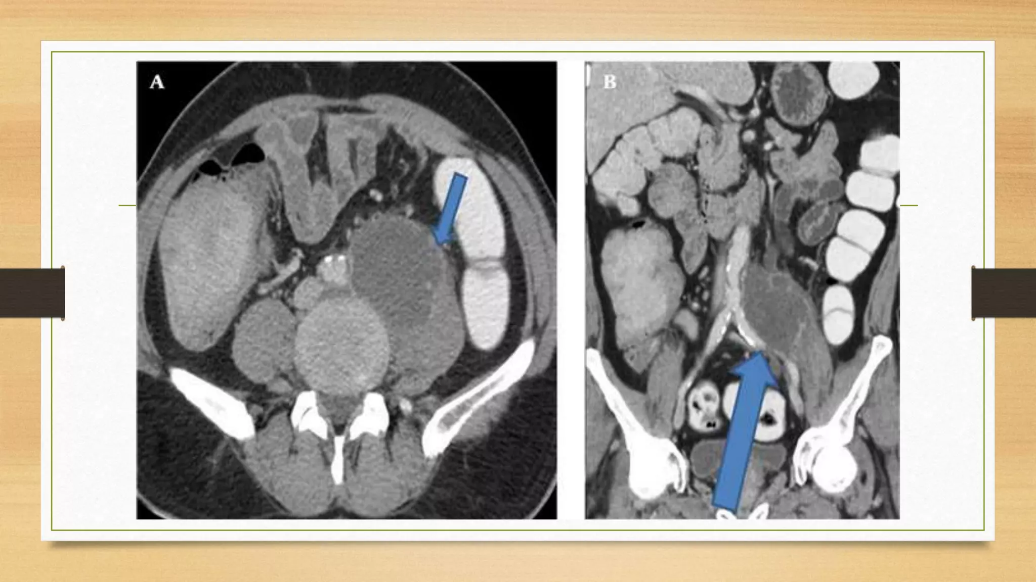 Psoas abscess | PPTX