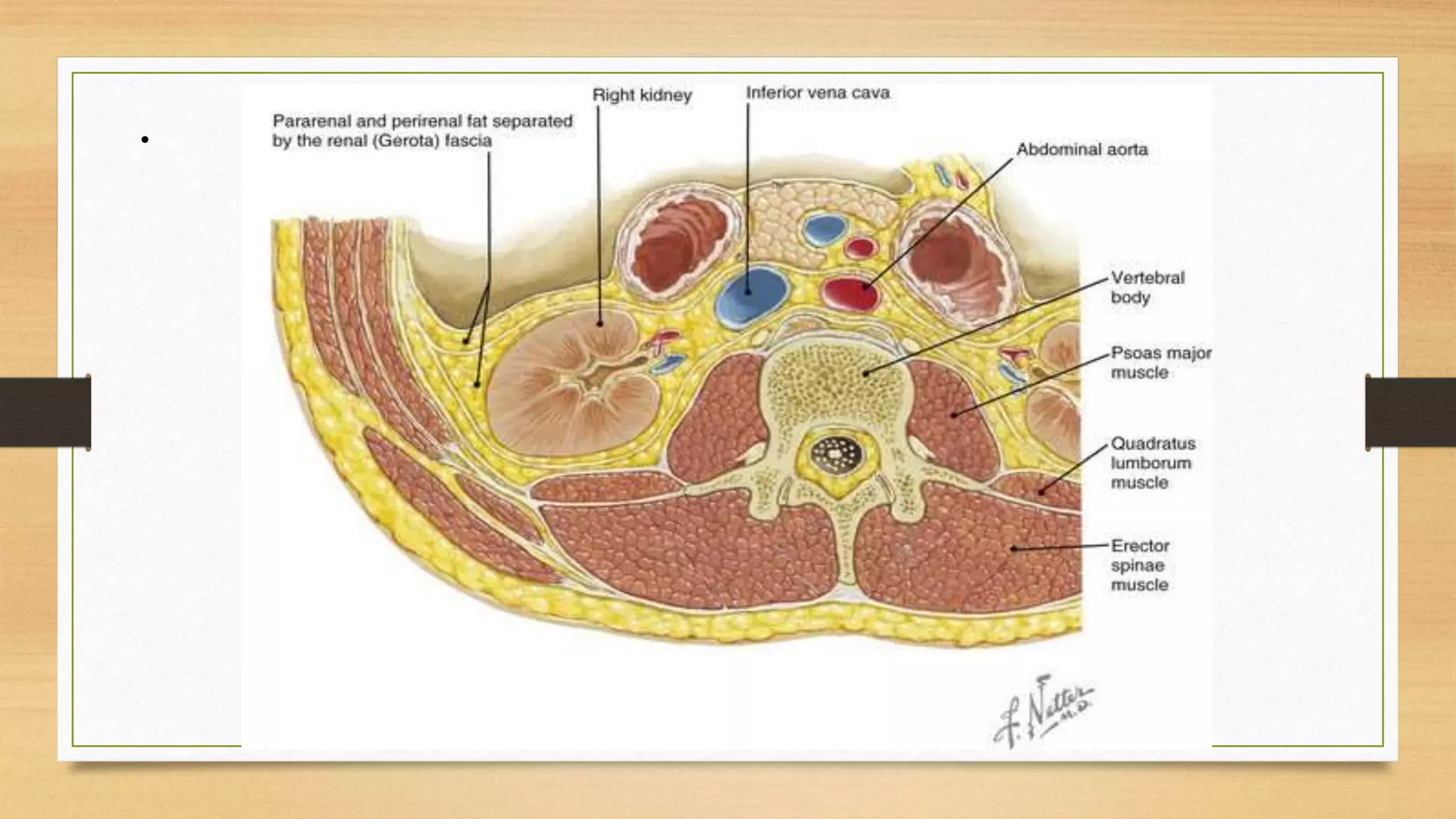 Psoas abscess | PPTX