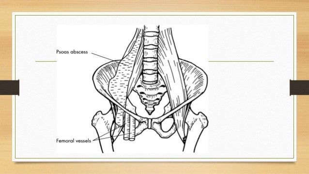Psoas abscess