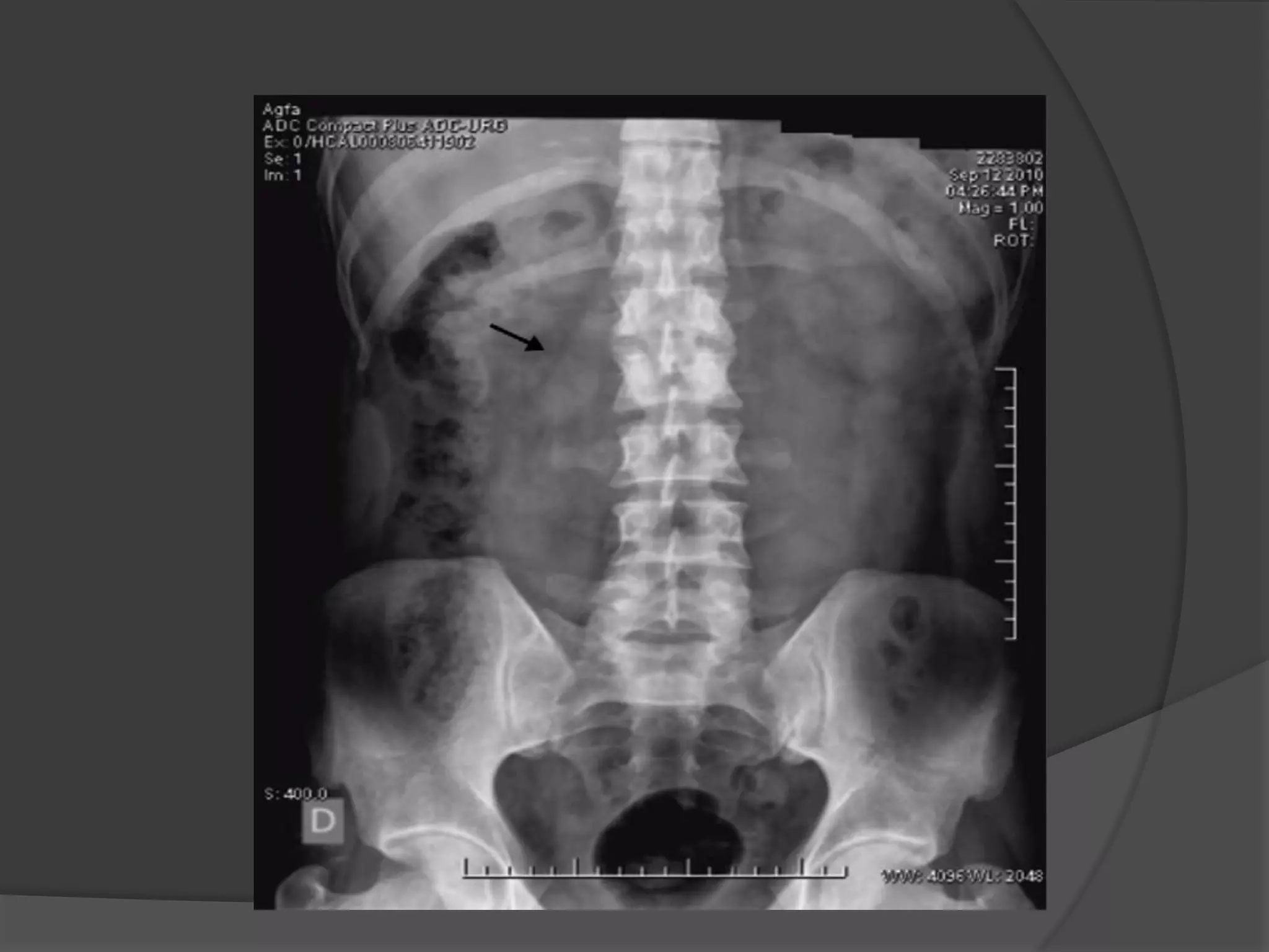 Psoas abscess | PPTX