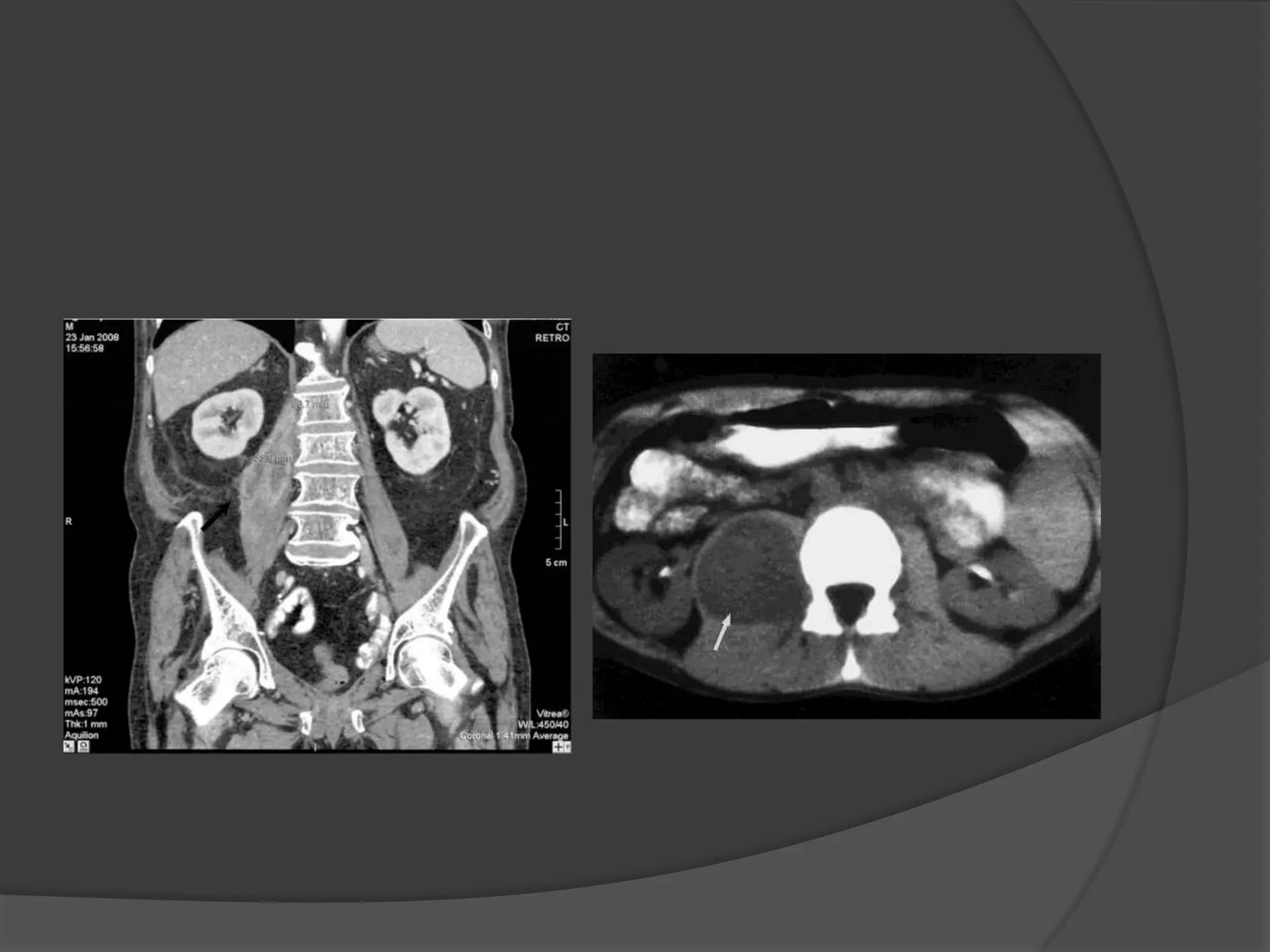 Psoas abscess | PPTX