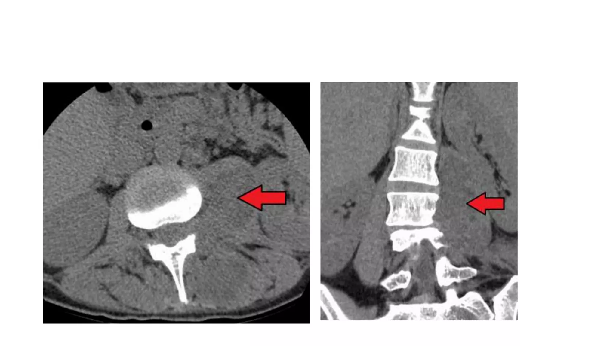 Psoas abscess | PPTX