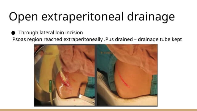 Psoas abses in adult pediatric and management | PPT