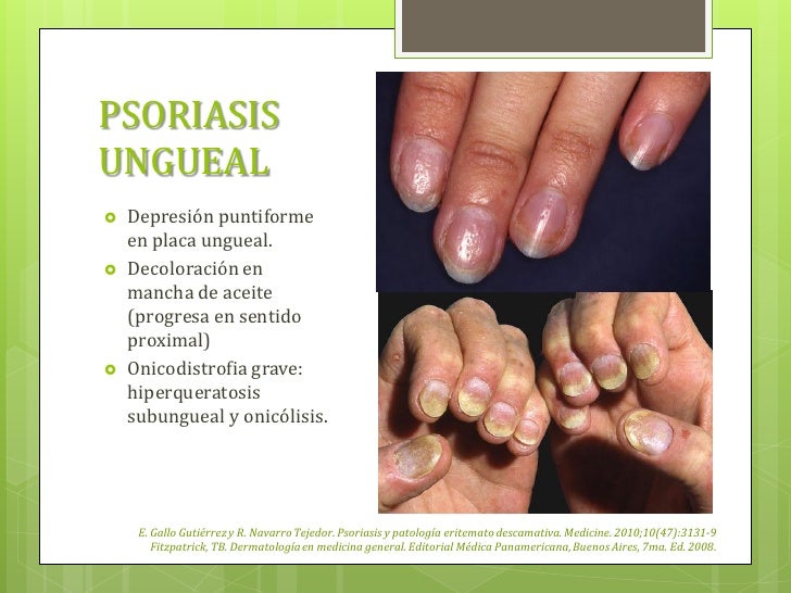 Psoriasis