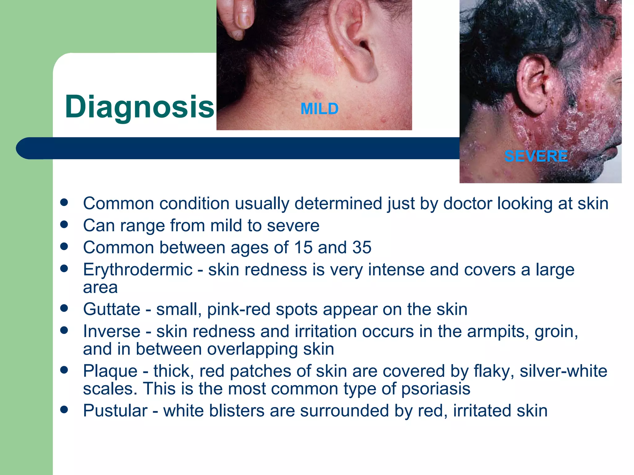 Psoriasis | PPT