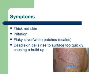 Psoriasis | PPT
