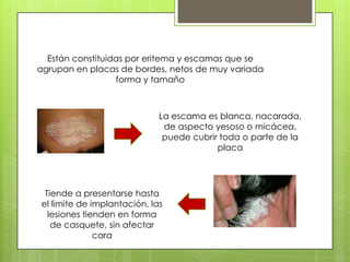 Psoriasis | PPTX