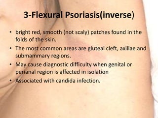Psoriasis | PPT