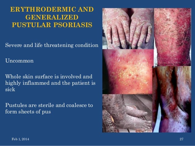 Psoriasis