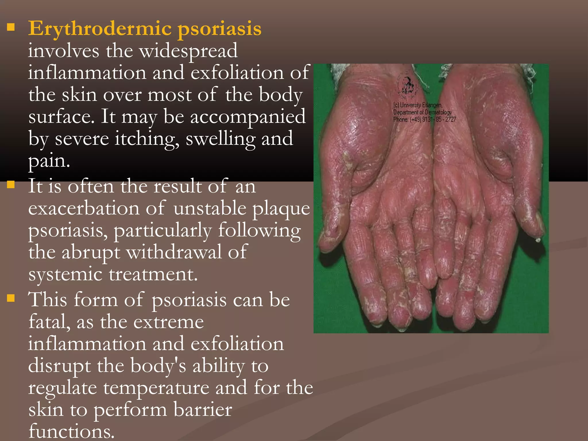 Psoriasis | PPT