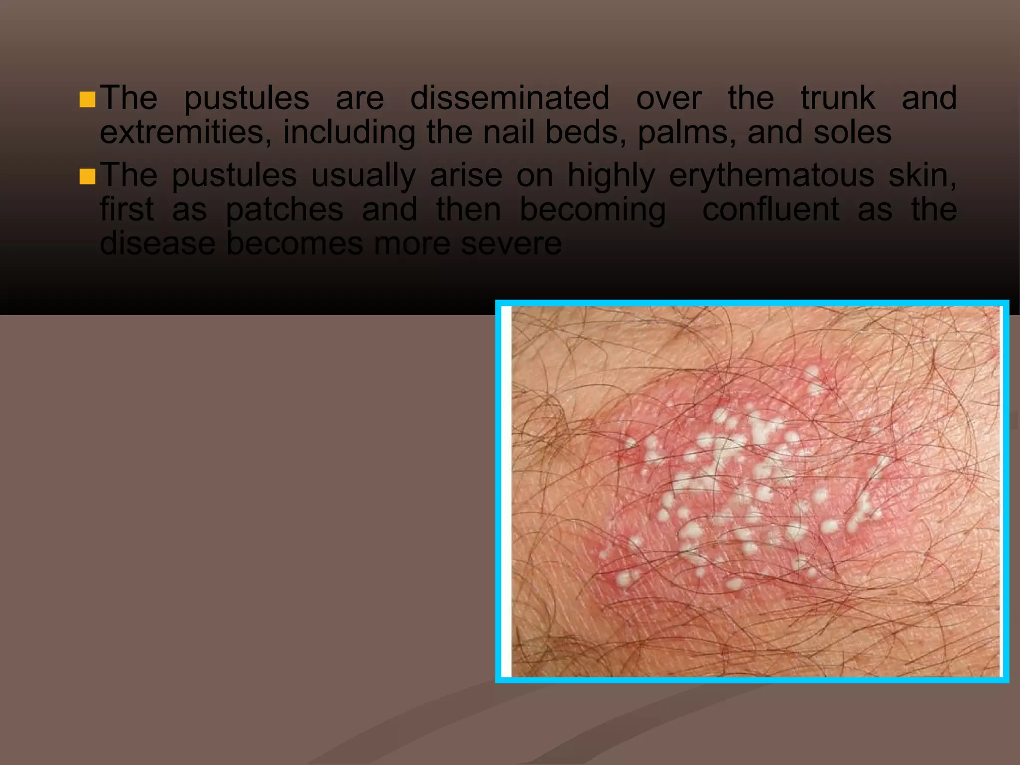 Psoriasis | PPT