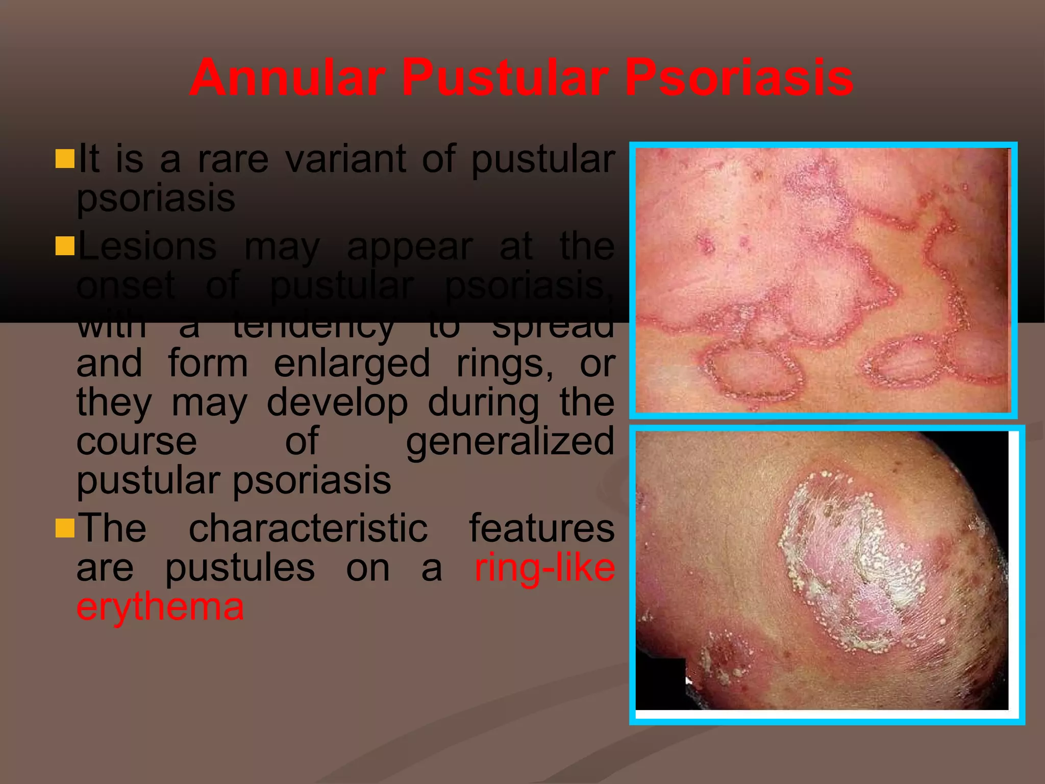 Psoriasis | PPT