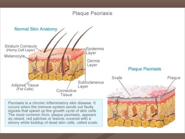 Psoriasis | PPT | Skin and Dermatology | Diseases and Conditions