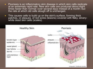 Psoriasis | PPT