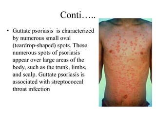 Psoriasis | PPTX