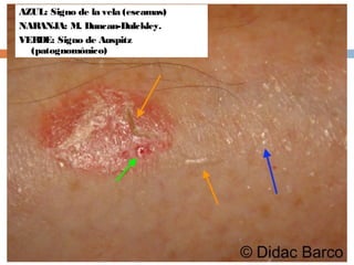 Psoriasis | PPT