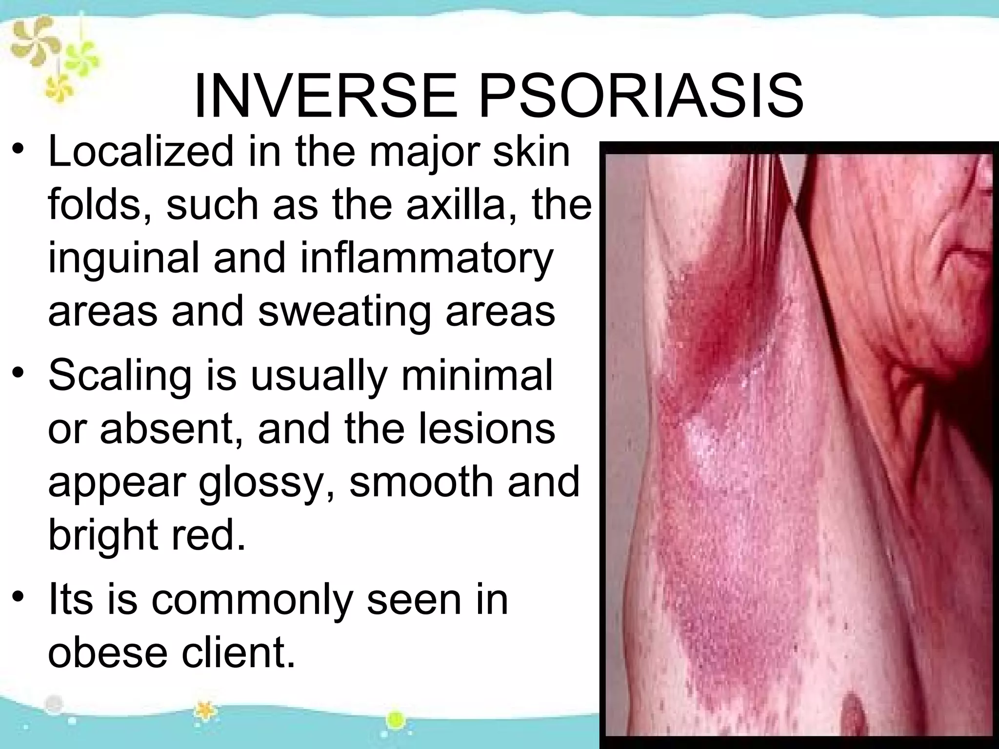 Psoriasis | PPT