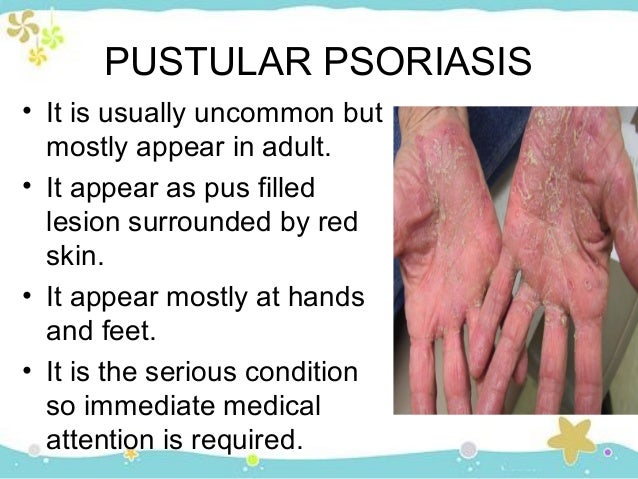 Psoriasis