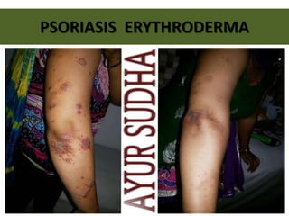 Psoriasis Ayurvedic Treatment Centre in Punjab, India | PPTX