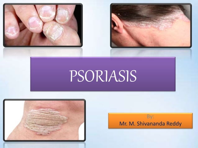 Psoriasis | PPTX