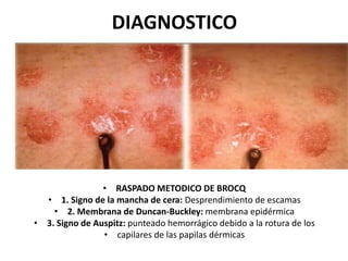 Psoriasis. | PPTX
