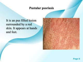 psoriasis-170709132604.pdfbbhvvvvvvvvvggg | PDF
