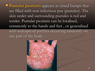 Psoriasis | PPT