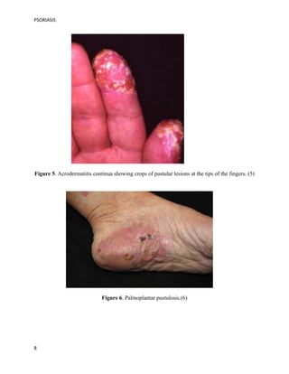 Psoriasis 2018 | PDF