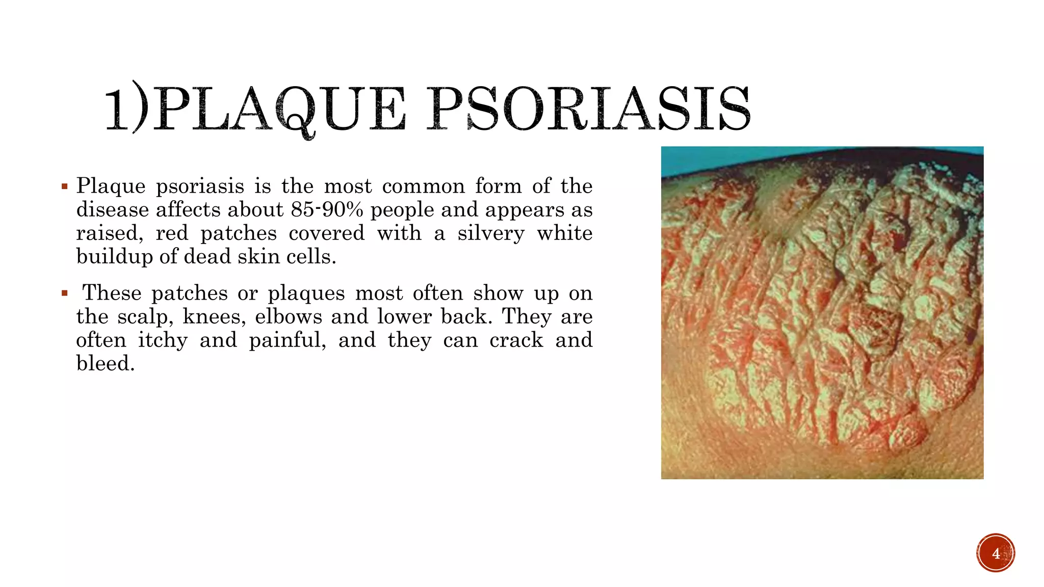 Psoriasis | PPTX