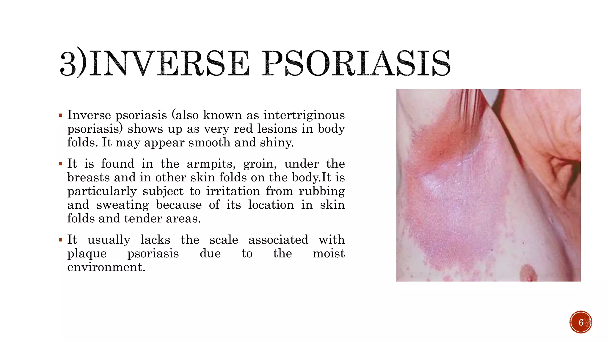 Psoriasis | PPTX