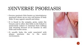 Psoriasis | PPTX
