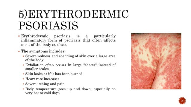 Psoriasis | PPTX | Skin and Dermatology | Diseases and Conditions