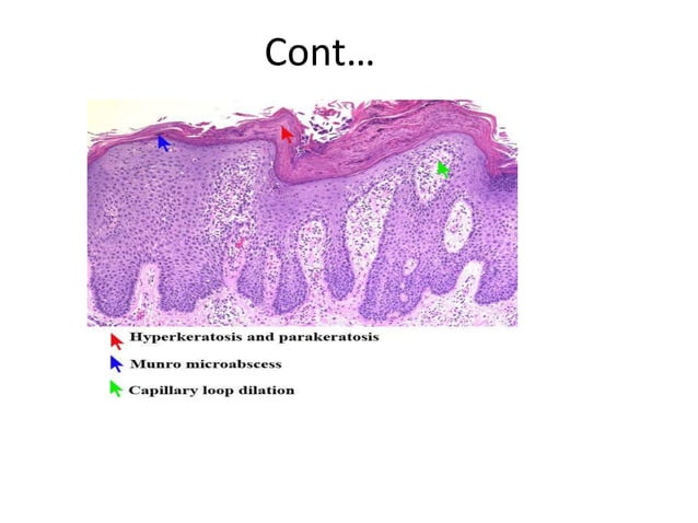Psoriasis | PPT