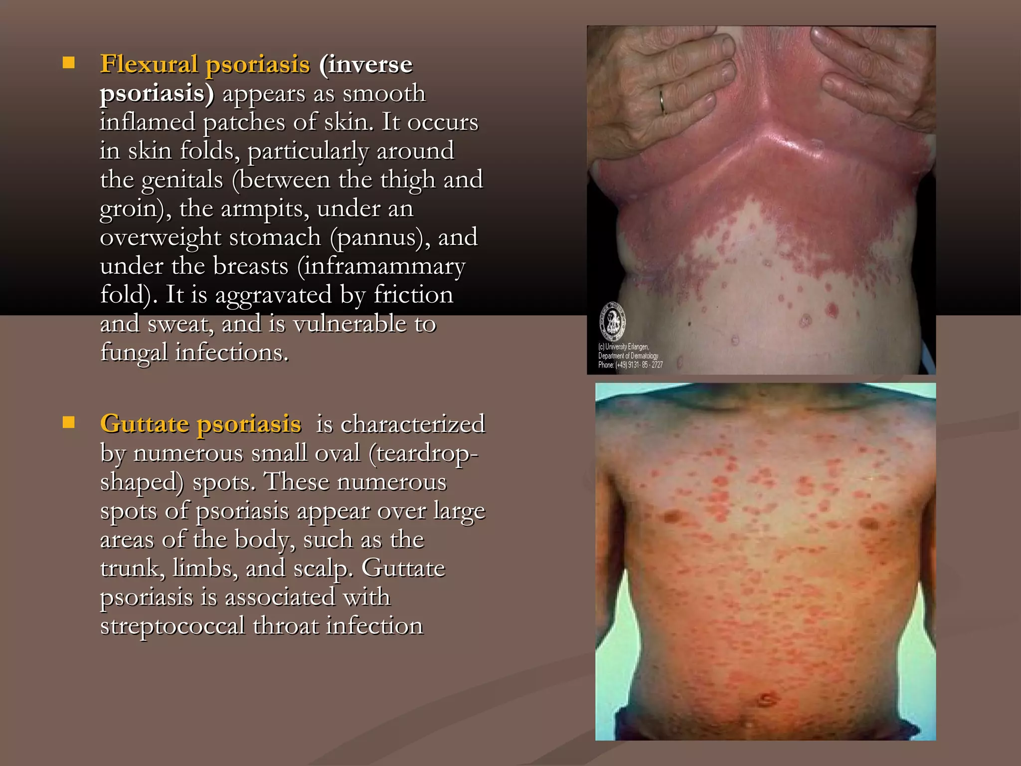 Psoriasis | PPT